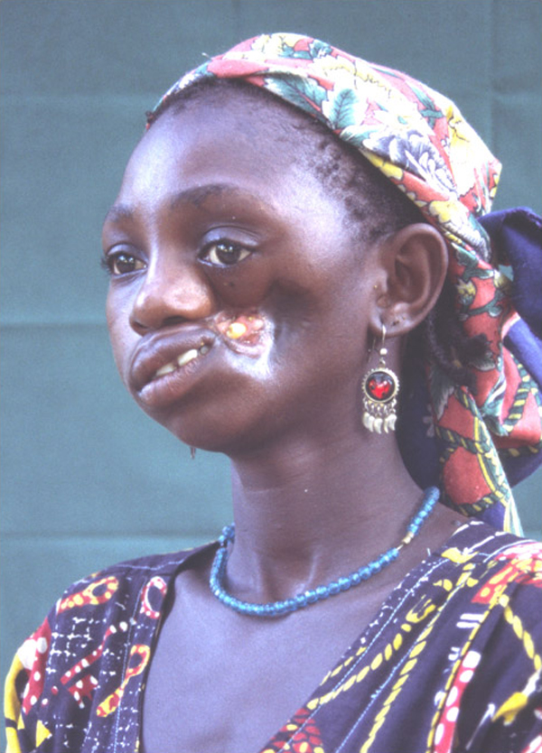 Noma Before And After